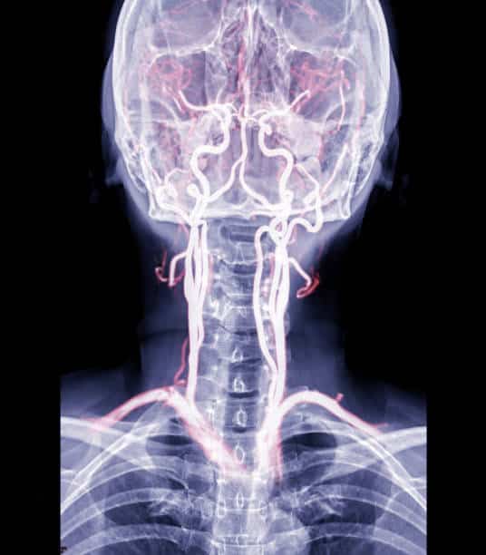 Cervical Fusion Surgery in Houston - NW Surgery