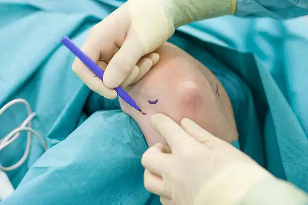 Tennis Elbow Surgery in Houston | NW Surgery